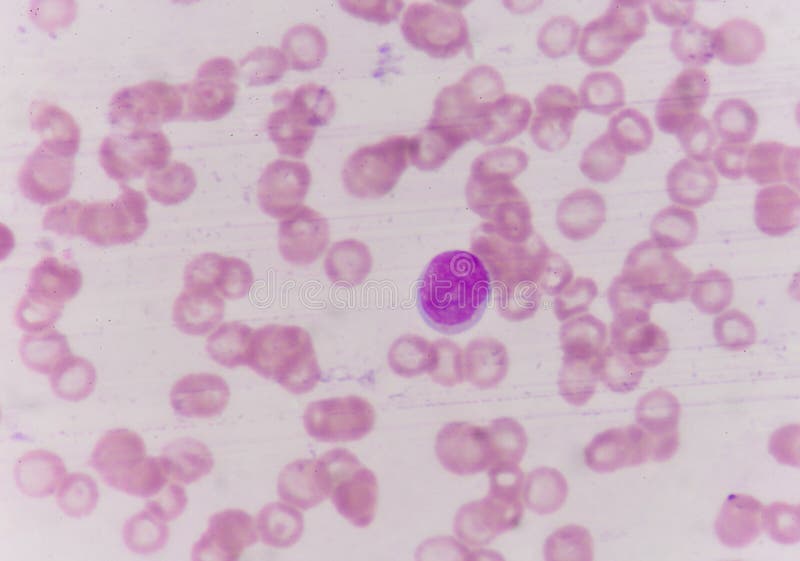 Blast Cells in Blood Smear. Stock Image - Image of monocyte, macrocyte ...