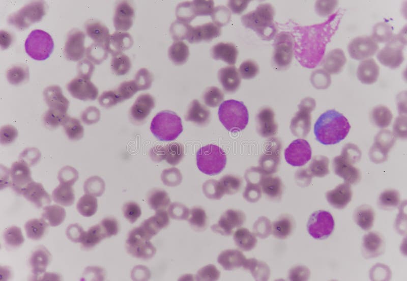 Blast cells in Leukemia stock photo. Image of disease - 98411570