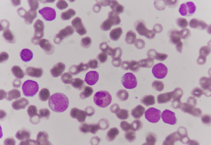 Blast Cells of White Blood Cell. Stock Photo - Image of background ...