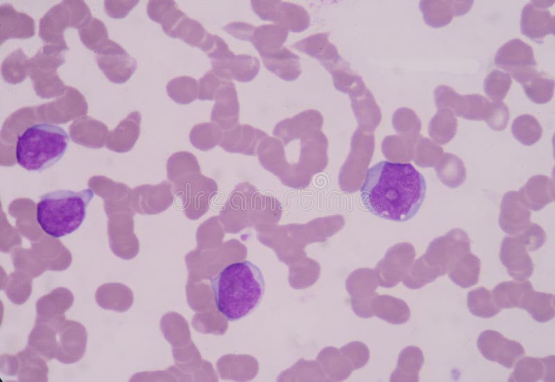 Blast Cells of White Blood Cell. Stock Photo - Image of background ...