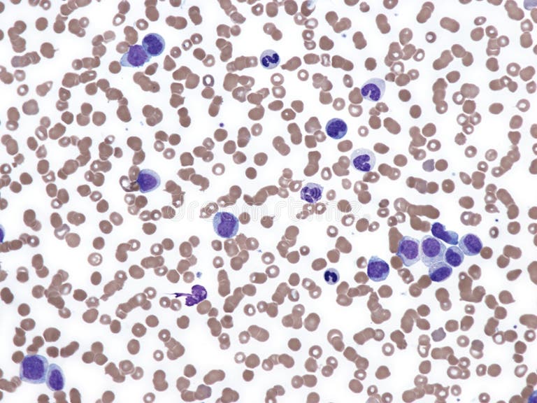 Blast Phase of Essential Thrombocythemia. Stock Image - Image of blast ...