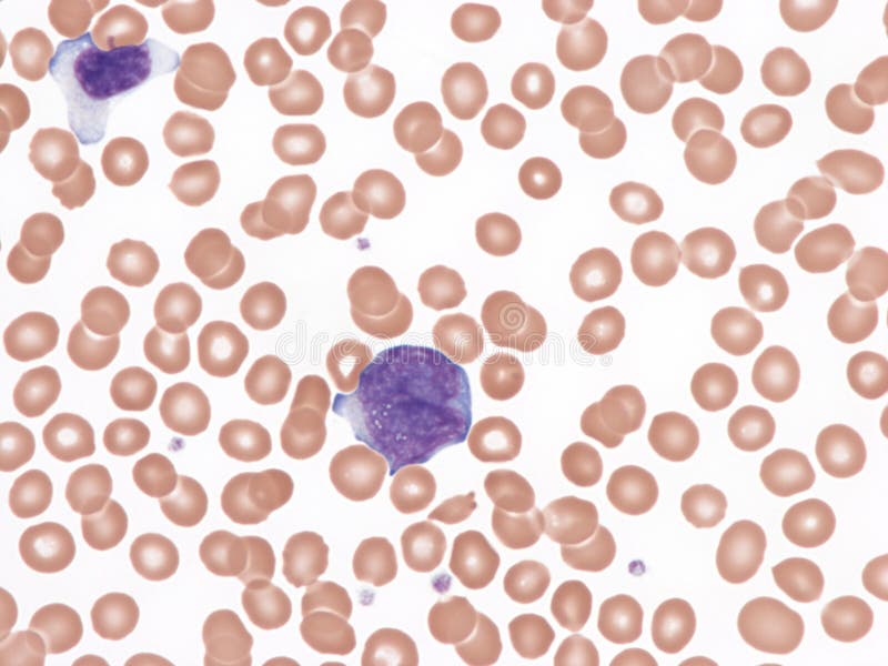 B-cell Lymphoma in Pleural Fluid Stock Photo - Image of mitoses ...