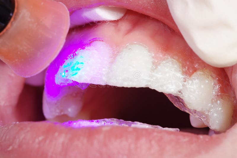 Bleaching close up stock image. Image of hygiene, cosmetic - 39468875