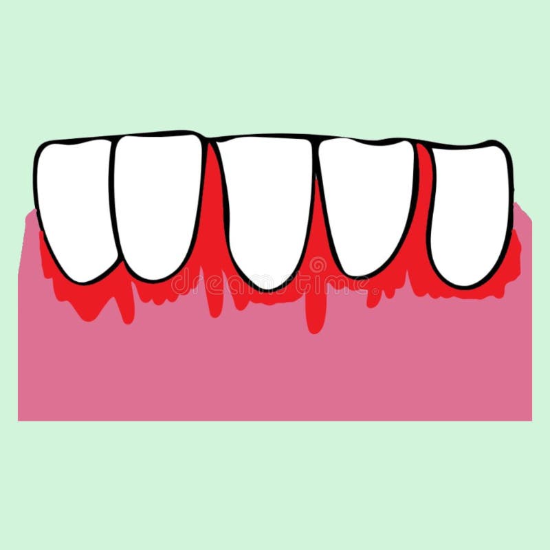Bleeding gums - 1 stock illustration. Illustration of dentistry - 370074278