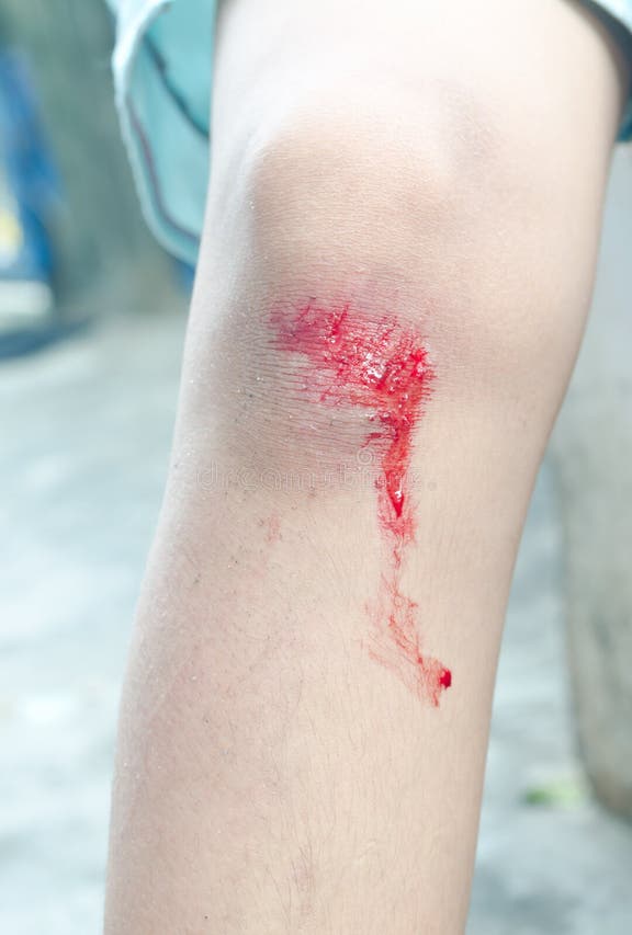 Bleeding Scraped Human Knee Stock Image - Image of human, asian: 77106989