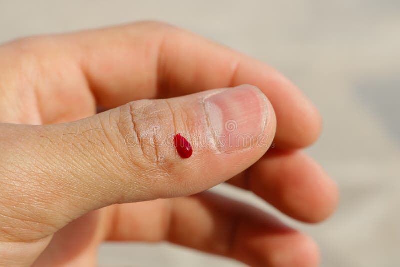 Bleeding from a Thumb Injury Stock Photo - Image of diabetes, finger ...