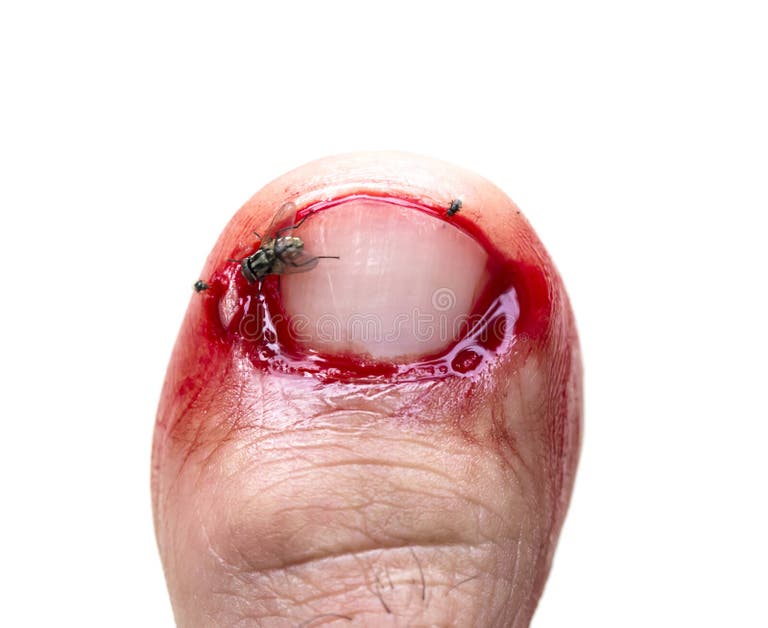 Bleeding at toe. stock photo. Image of condition, pain - 32086294