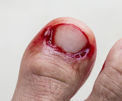 Bleeding at toe. stock image. Image of condition, flesh - 31709735
