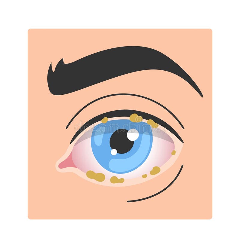 Blepharitis Human Eye Disease Stock Vector - Illustration of eyeball ...