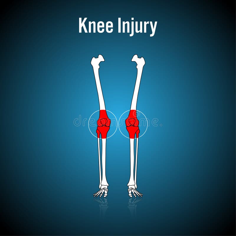 Illustration De Blessure Au Genou Illustration Stock - Illustration du ...