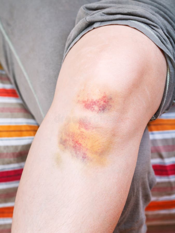8,107 Photos de Contusion - Photos de stock gratuites et libres de ...