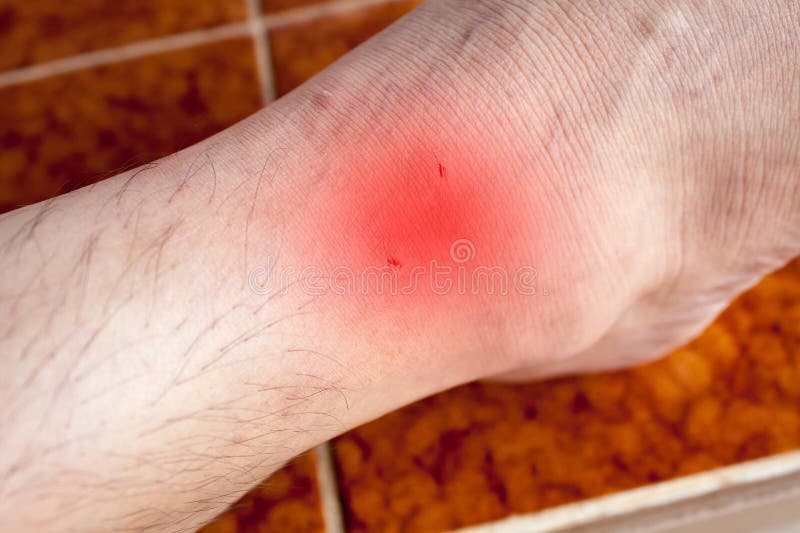 Infection De Blessure De Blessure De Morsure De Chien Image stock ...