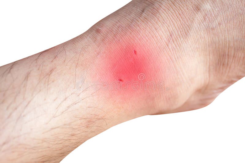 Blessure au bas de la page photo stock. Image du ampoule - 48195708