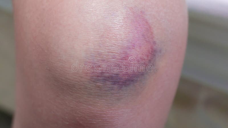 Bleu Et Bleu Sur Un Genou D'homme Image stock - Image du contusion ...