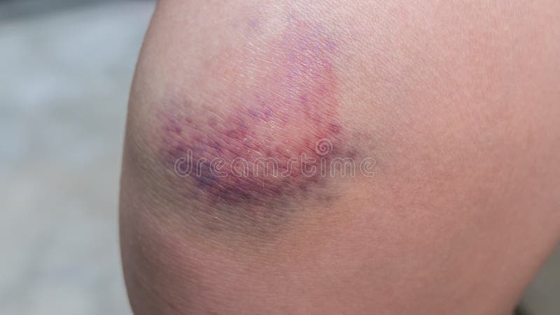 Blessure De Contusion Sur Le Genou Photo stock - Image du contusion ...