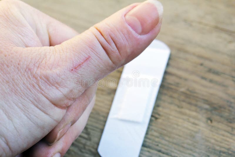 Blessure infectée image stock. Image du cicatrice, amputation - 65179897