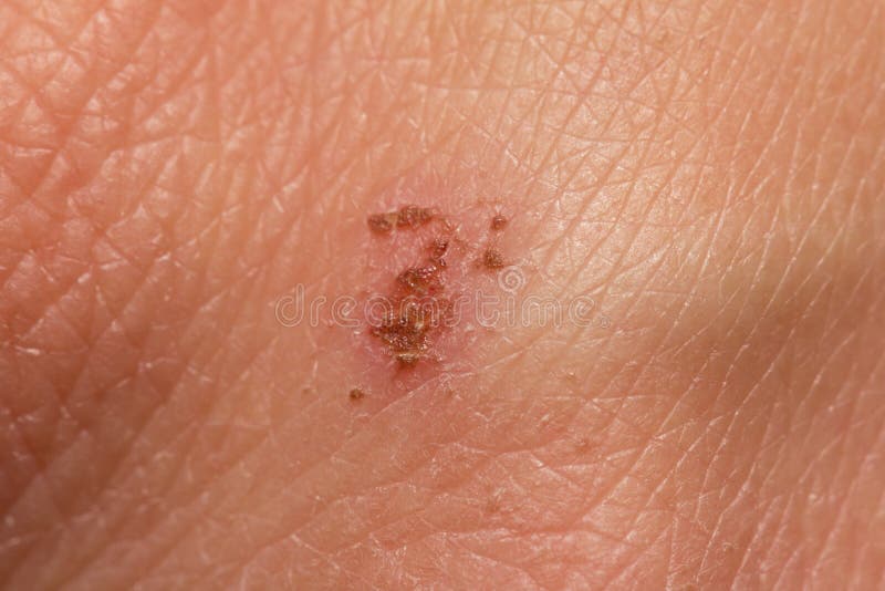 2,945 Blessure Sur La Peau Photos libres de droits et gratuites de ...