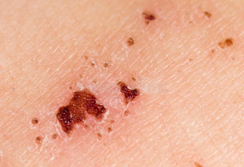 2,945 Blessure Sur La Peau Photos libres de droits et gratuites de ...