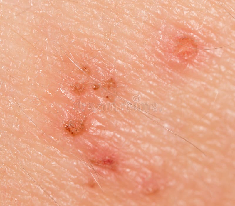 Blessure Sur La Peau D'une Personne Image stock - Image du blessures ...