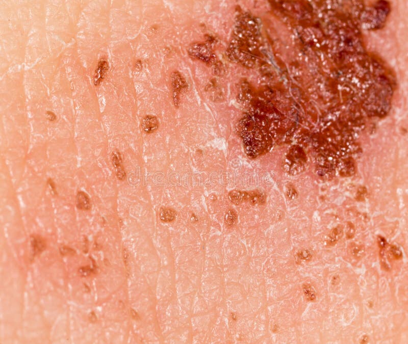 2,945 Blessure Sur La Peau Photos libres de droits et gratuites de ...