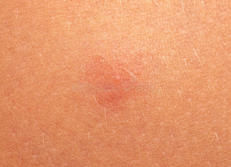 Blessure Sur La Peau D'une Personne. Photo stock - Image du sang, fille ...