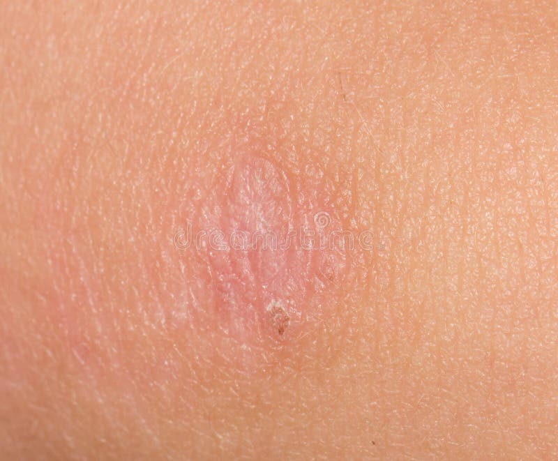 Une blessure sur la peau image stock. Image du blessures - 88013539