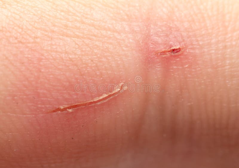 Une blessure sur la peau image stock. Image du blessures - 88013539