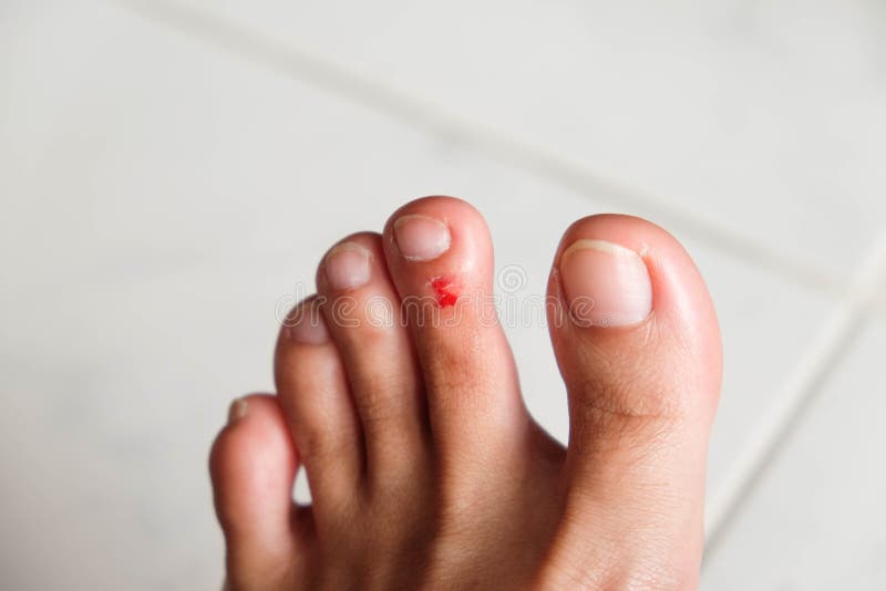 Blessure d'abcès photo stock. Image du over, rouge, infection - 43444590