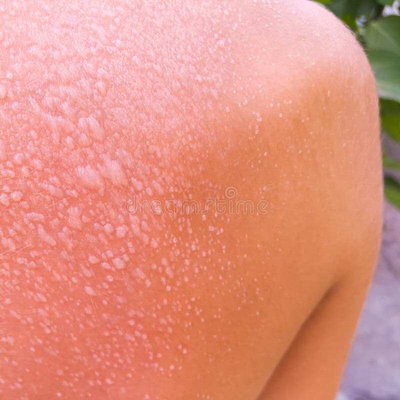 Blisters on the Back from Sunburn. a Young Guy on Vacation at the Beach ...