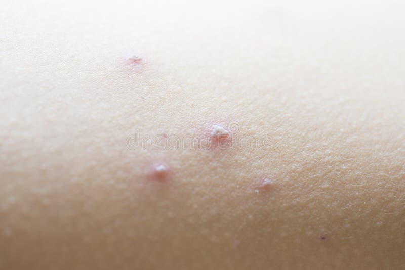 Blisters Occur in Various Areas on the Skin of the Body Stock Image ...