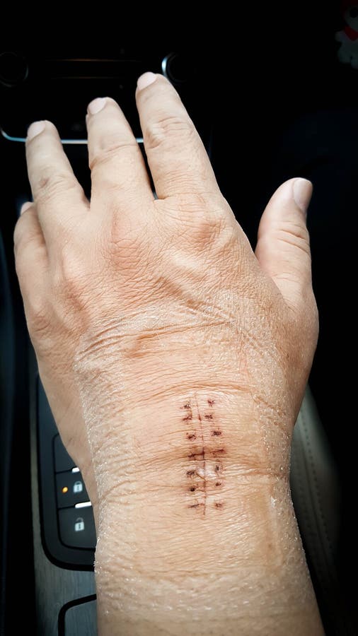 Blisters Scab on Stitched Wound on Man Hand Stock Image - Image of ...