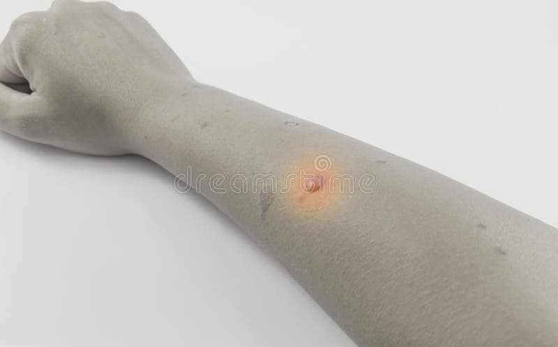 Blisters on skin arm stock image. Image of blister, acid - 77907761