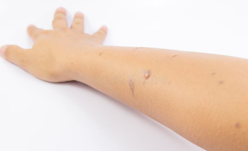 Scald Burn Blister Forearm Photos - Free & Royalty-Free Stock Photos ...