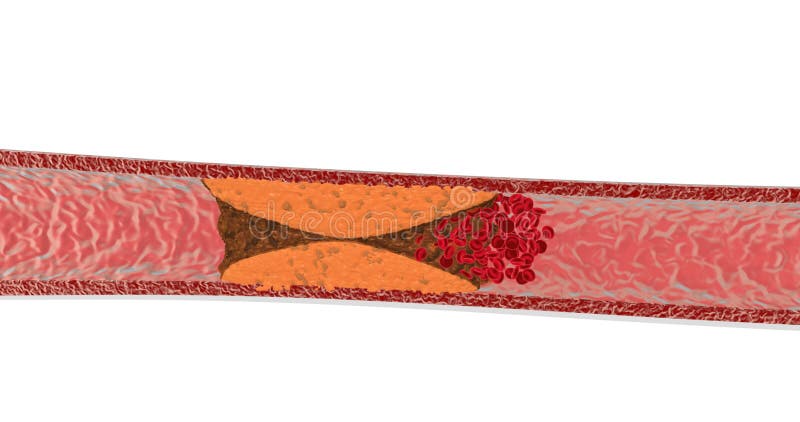 Blocked Blood Vessel 3D Render Stock Illustration - Illustration of ...