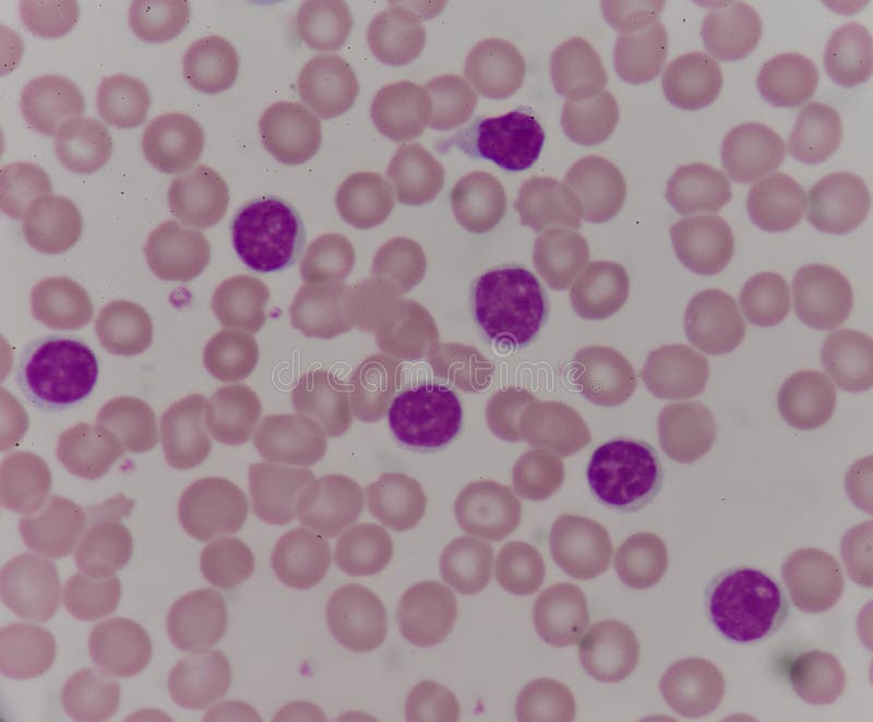 Fresh Red Blood Cells in CSF Fluid Stock Image - Image of artery ...