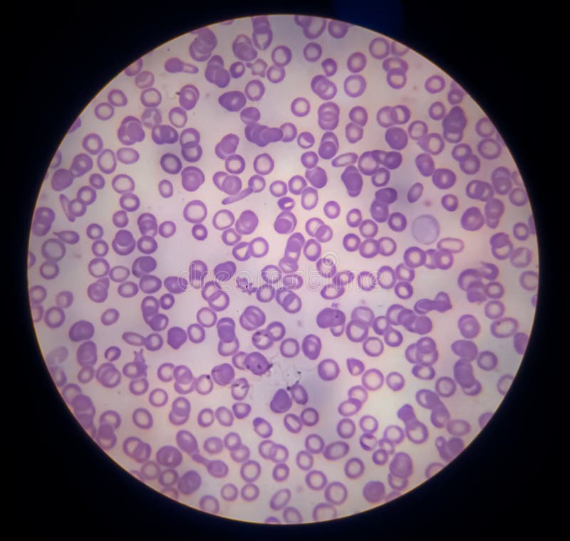 Microscopic (Magnification) of Human Blood, Hematologic Disease. Stock ...