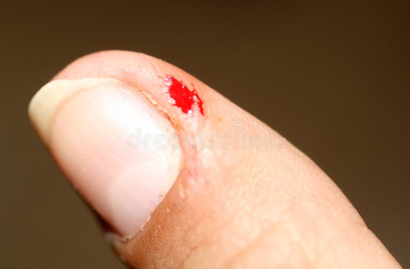 Blood Crack on the Thumb. Burr on the Skin Stock Photo - Image of ...