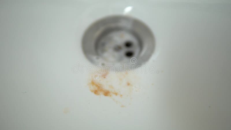 Drops of the Fresh Blood Falling on the Drain on Sink while Brushing ...
