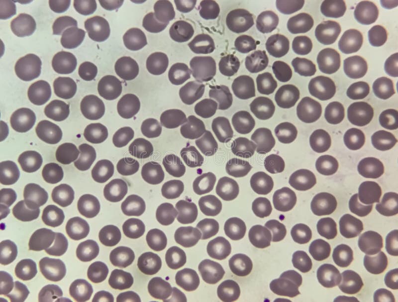 Blood Film Microscopic Show Decrease Platelets Leucocyte (WBC). Stock ...