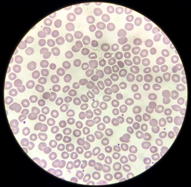 Blood Film Microscopic Show Decrease Platelets Leucocyte (WBC). Stock ...