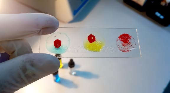 Blood Group Test by Slide Agglutination Method. Blood Grouping Stock ...