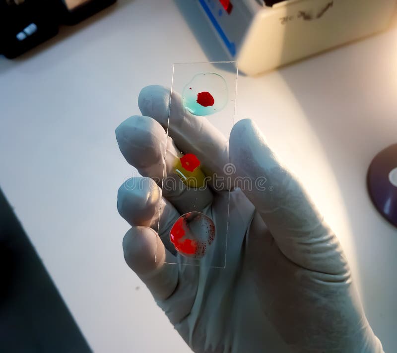 Blood Group Testing by Slide Agglutination Method. Stock Image - Image ...