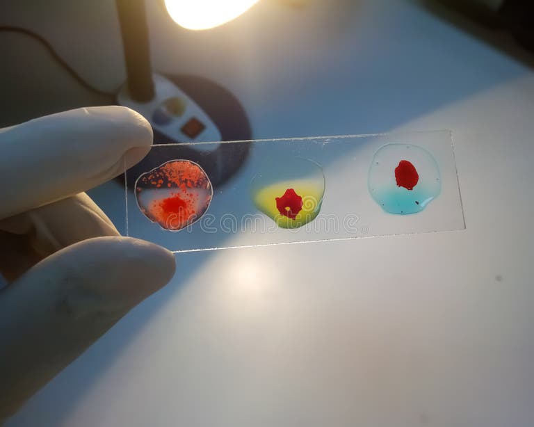 Blood Group Testing by Slide Agglutination Method in Lab Stock Image ...