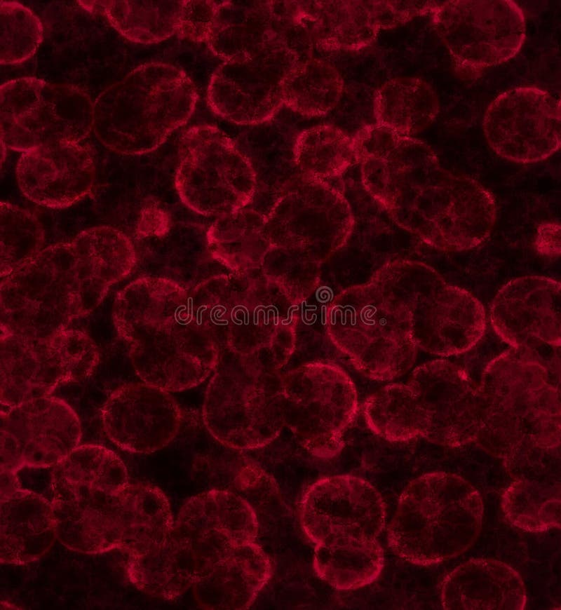 Blood with Infection Close-up. Infected Cells Under a Microscope Stock ...