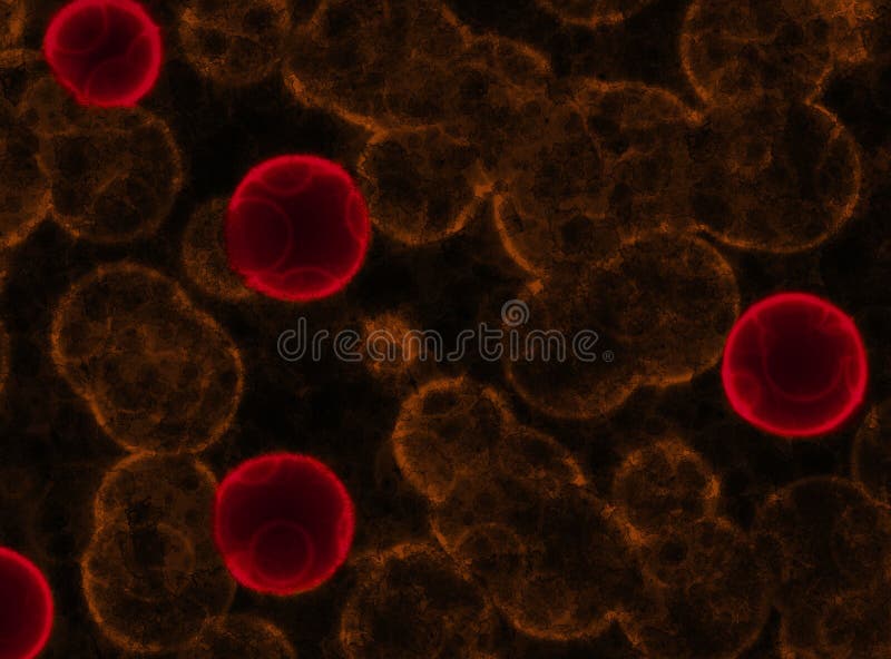 Blood with Infection Close-up. Infected Cells Under a Microscope Stock ...