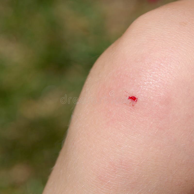 Blood on knee stock photo. Image of skin, wound, healthcare - 107666472