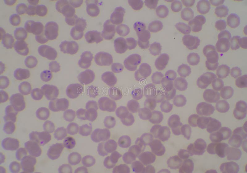Blood Parasite Infection Red Blood Cells Malaria Stock Image - Image of ...