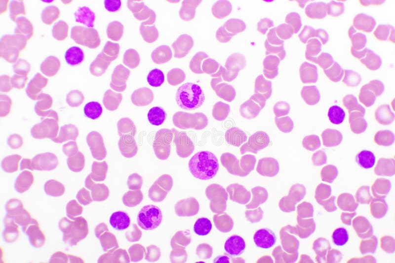 Blood Picture of Chronic Lymphocytic Leukemia or CLL Stock Image ...