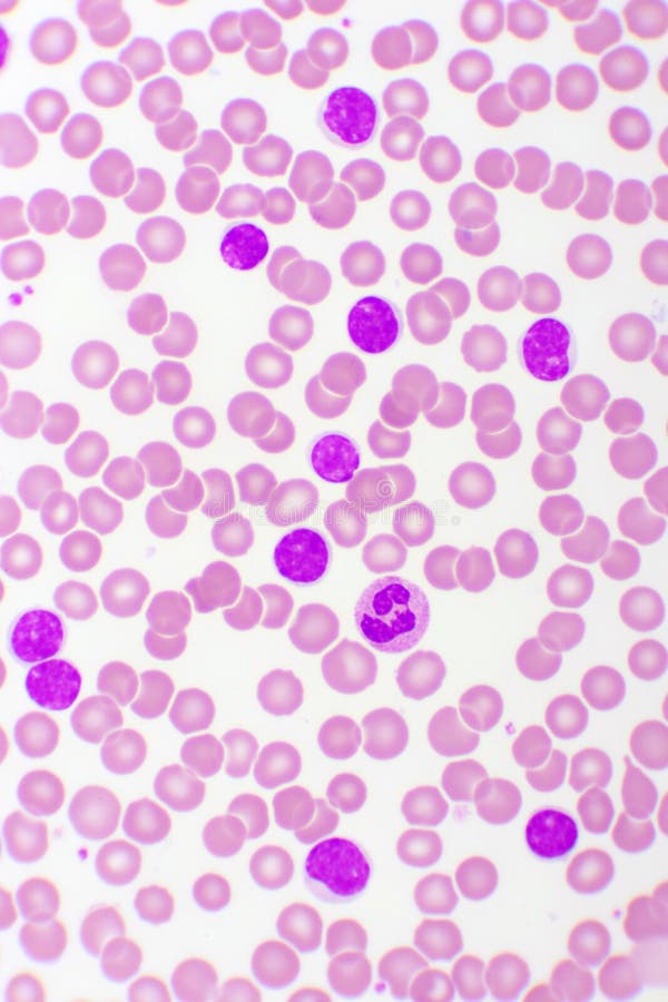 Blood Picture of Chronic Lymphocytic Leukemia or CLL Stock Photo ...