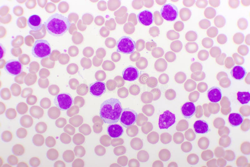 Blood Picture of Chronic Lymphocytic Leukemia Stock Photo - Image of ...